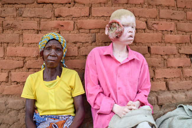 Indigent Zimbabweans with Albinism-Related Skin Cancer Turned Away From ...