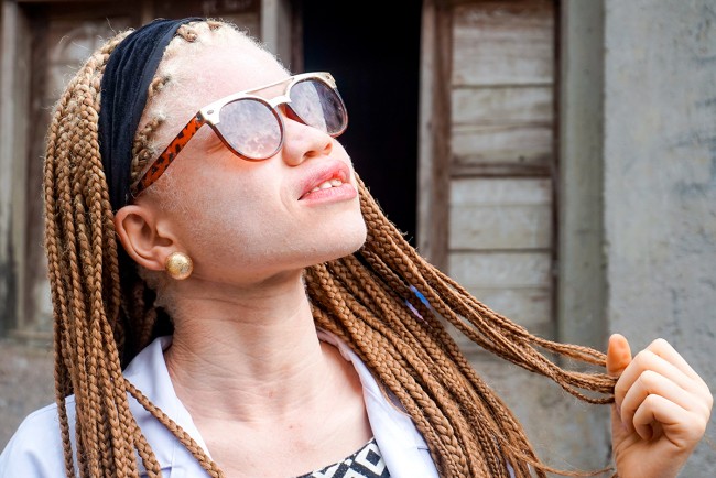 Changing Minds While Making Rounds, Resident With Albinism Defies Stigma